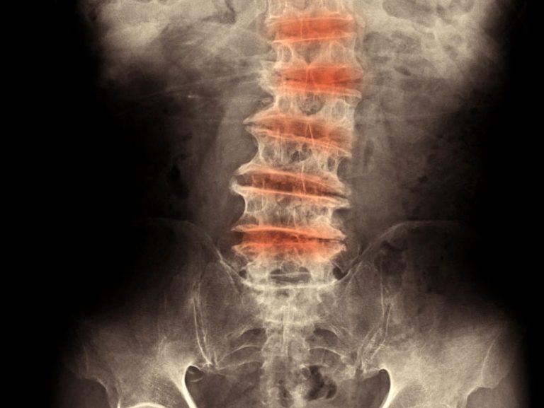 Ankylosing Spondylitis / Spondyloarthritis - Biomedcode