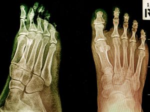 Ankylosing Spondylitis / Spondyloarthritis - Biomedcode