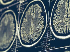 Multiple Sclerosis - Biomedcode